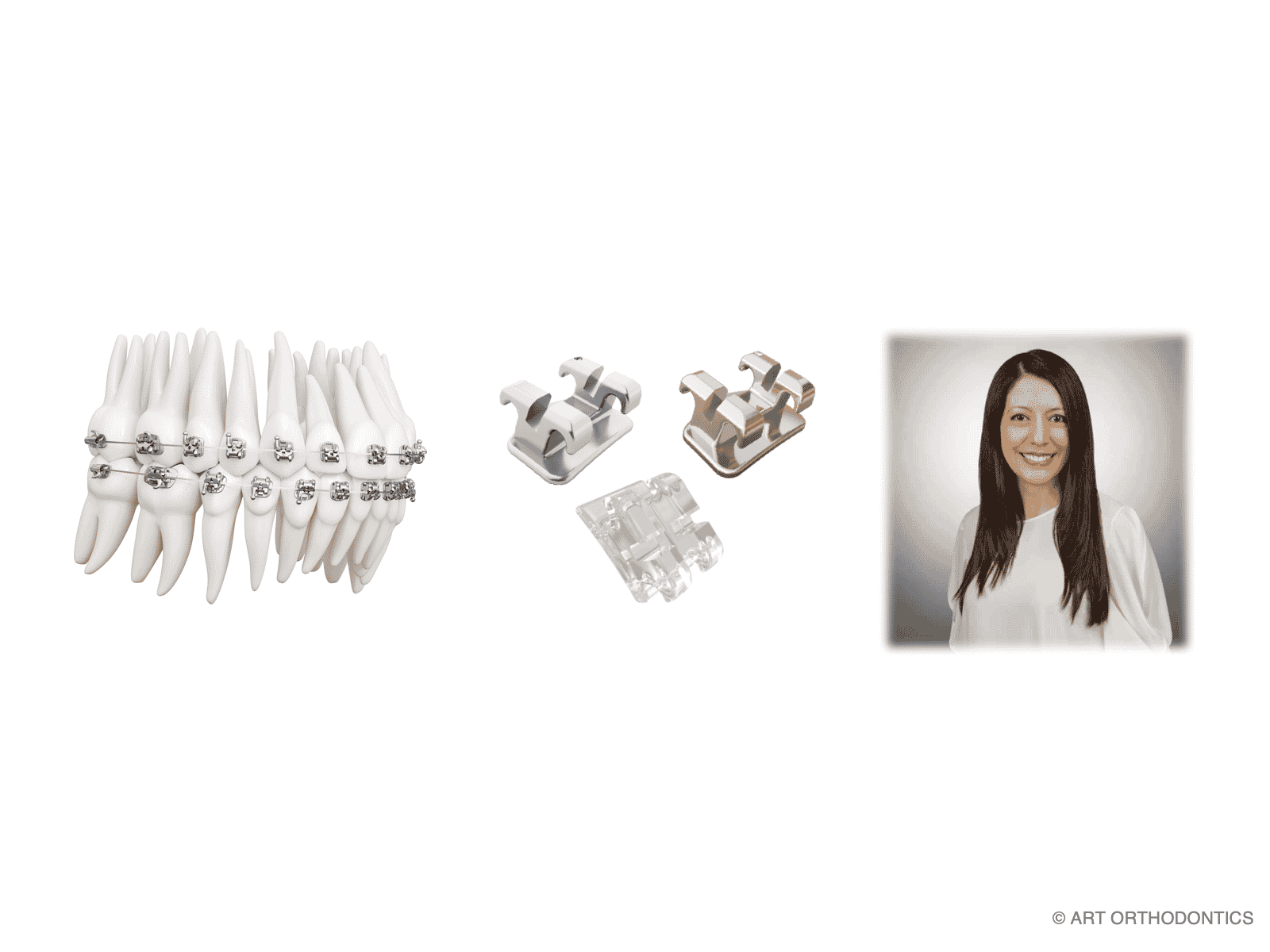 Brackets de ortodoncia: ¿cómo funcionan? | Ortodoncia ART