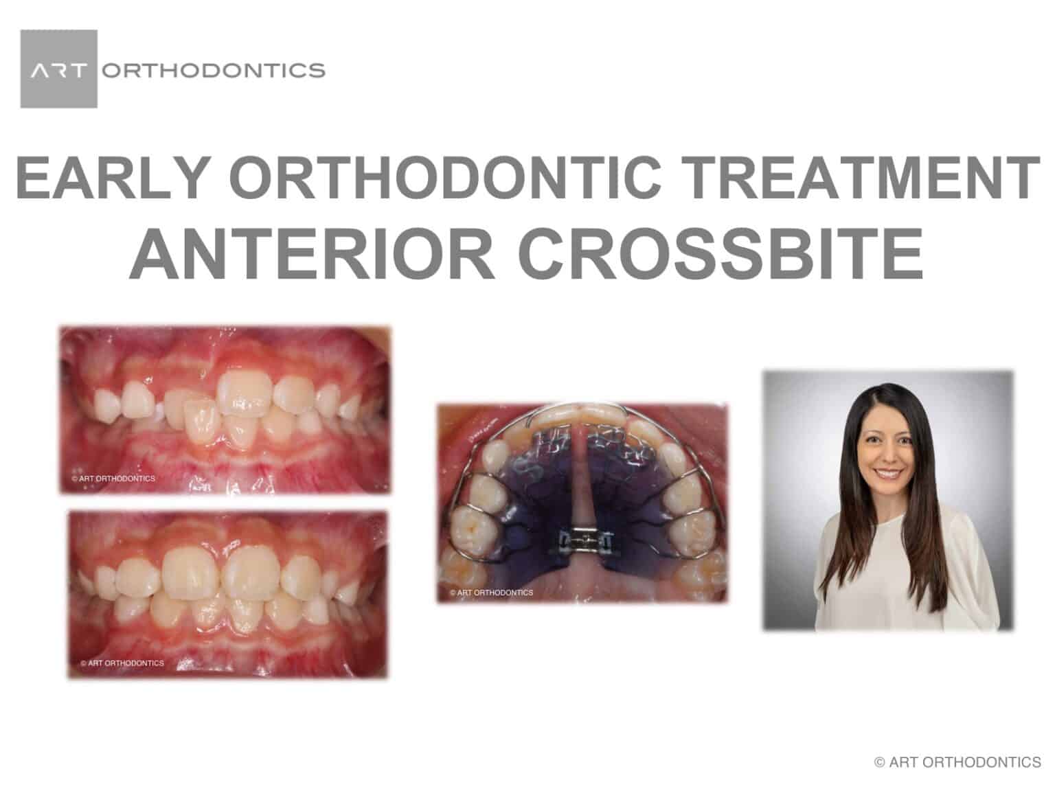 Early Orthodontics | Anterior Crossbite | ART Orthodontics