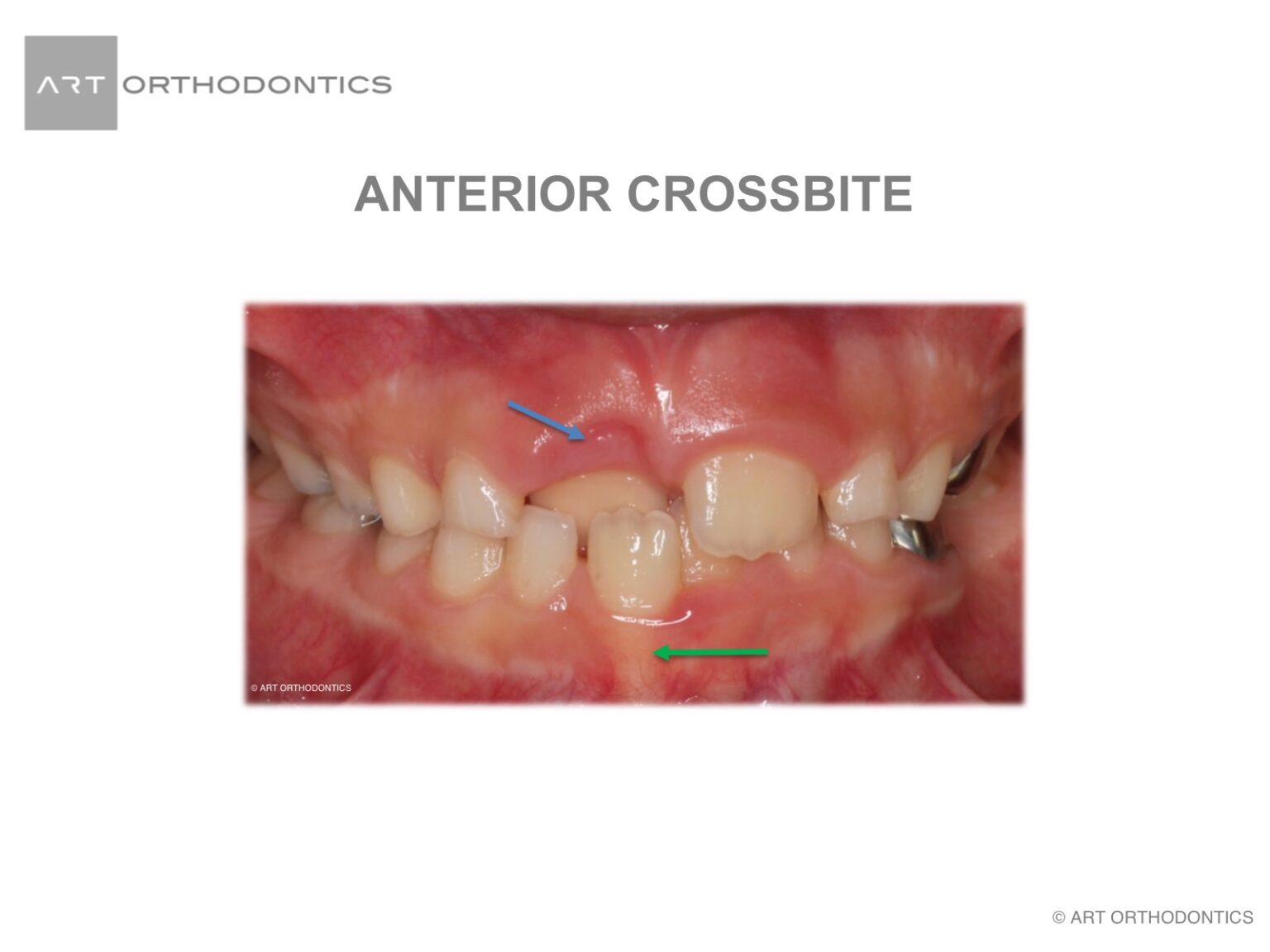 Early Orthodontics | Anterior Crossbite | ART Orthodontics