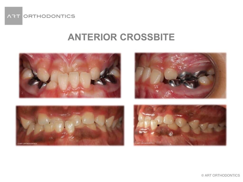 Early Orthodontics | Anterior Crossbite | ART Orthodontics