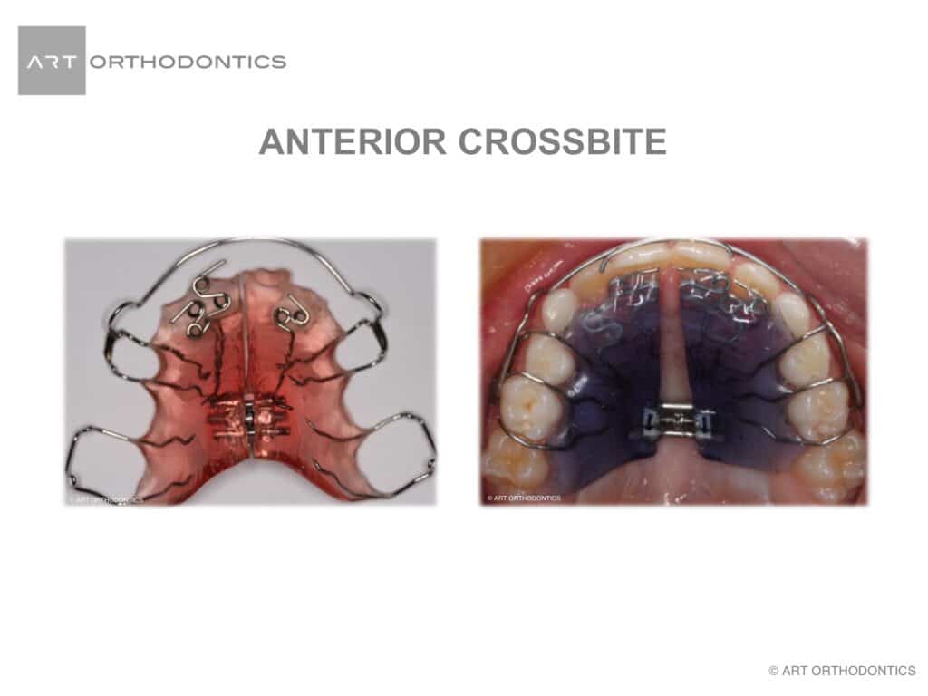 Early Orthodontics | Anterior Crossbite | ART Orthodontics